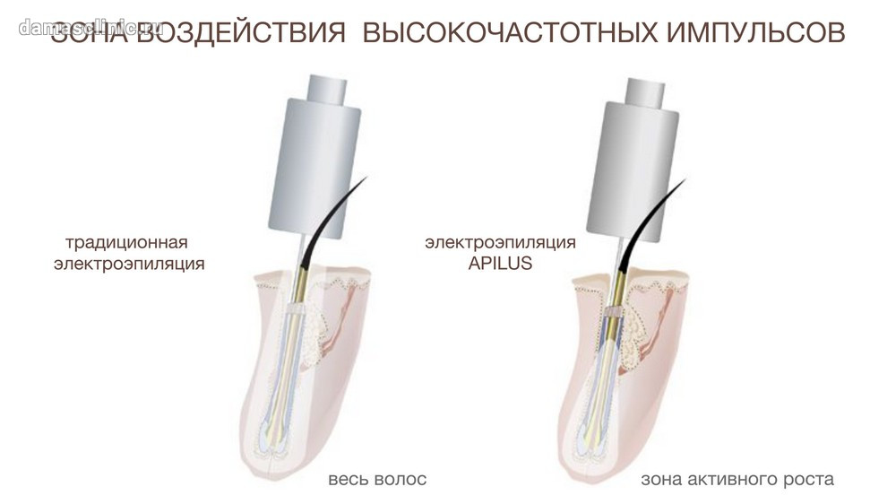 Электроэпиляция на аппарате APILUS / АПИЛУС зоны подмышек: фото до и ...